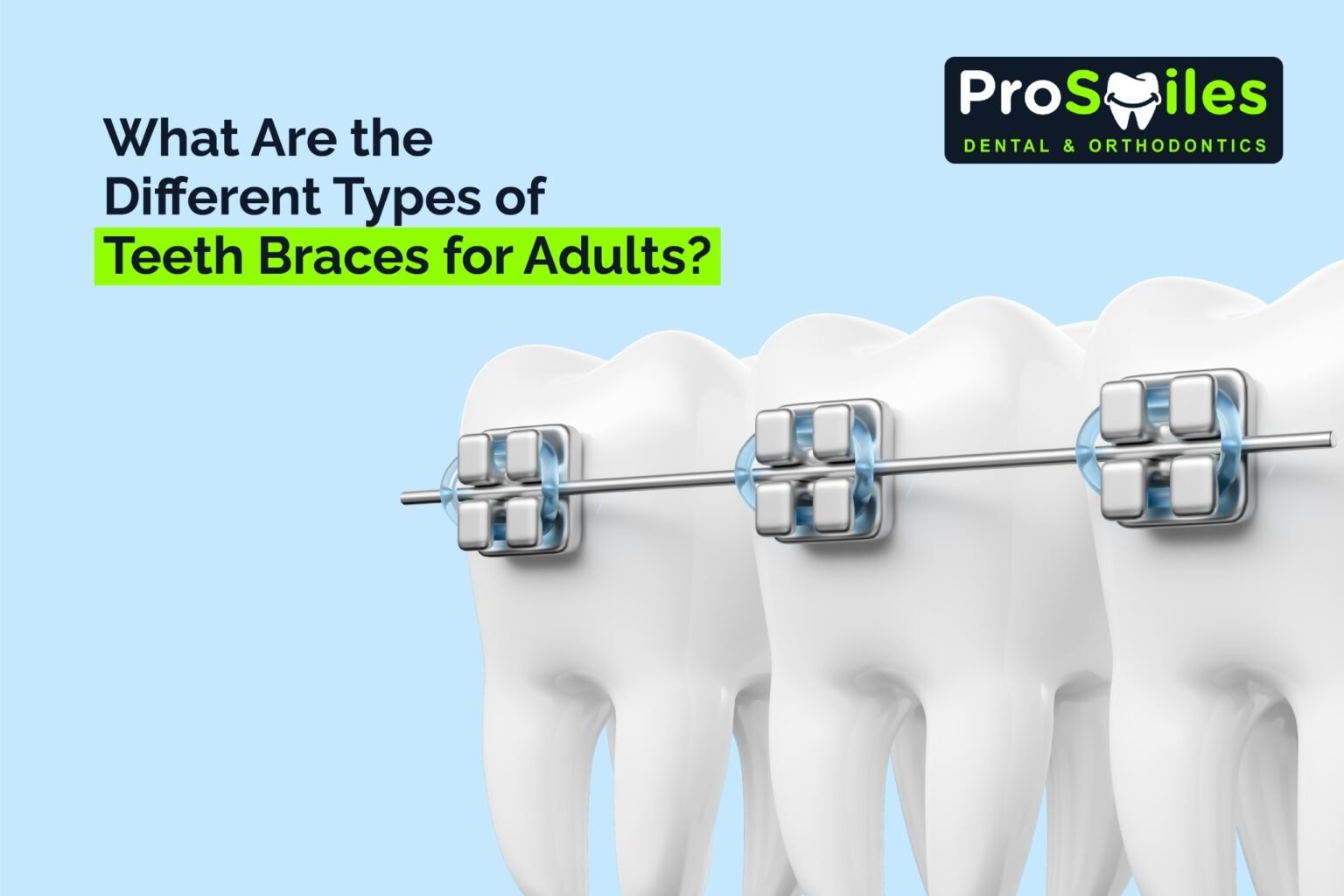 What Are the Different Types of Teeth Braces for Adults? — ProSmiles