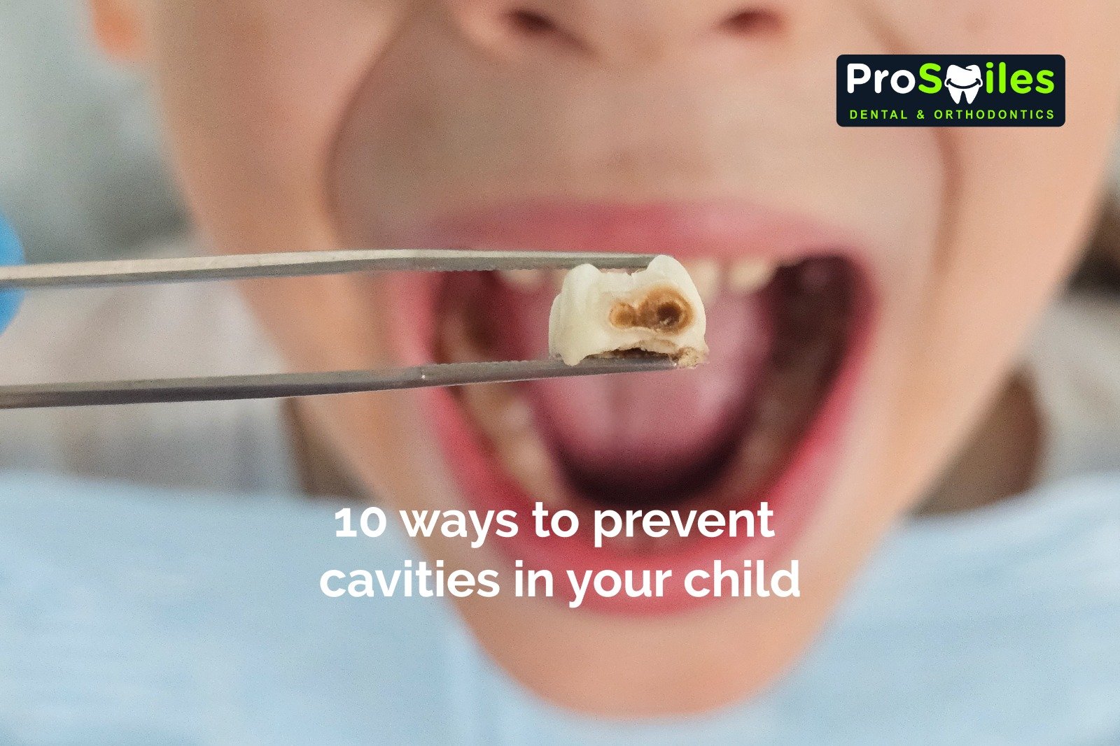 10 Ways to Prevent Cavities in Your Child — ProSmiles